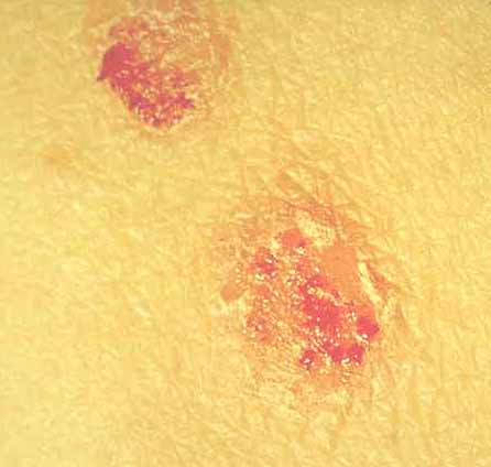 auspitz sign - meddic